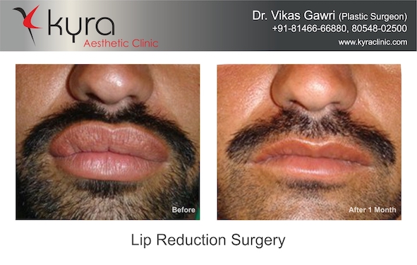 Plastic Surgery Lips Before And After | Lipstutorial.org